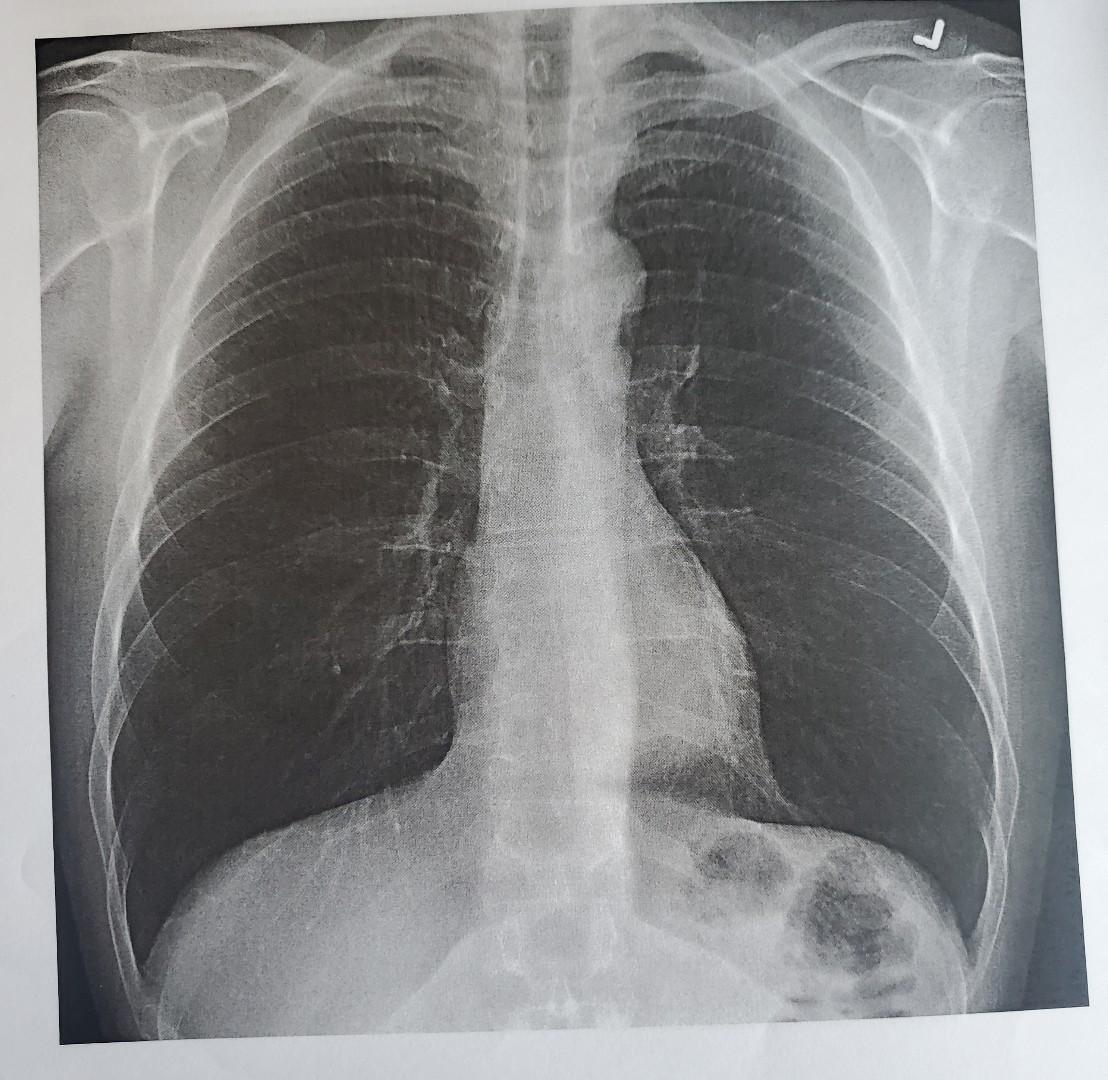 Solved 12- ﻿interpret this CXR and explain reasoning behind | Chegg.com
