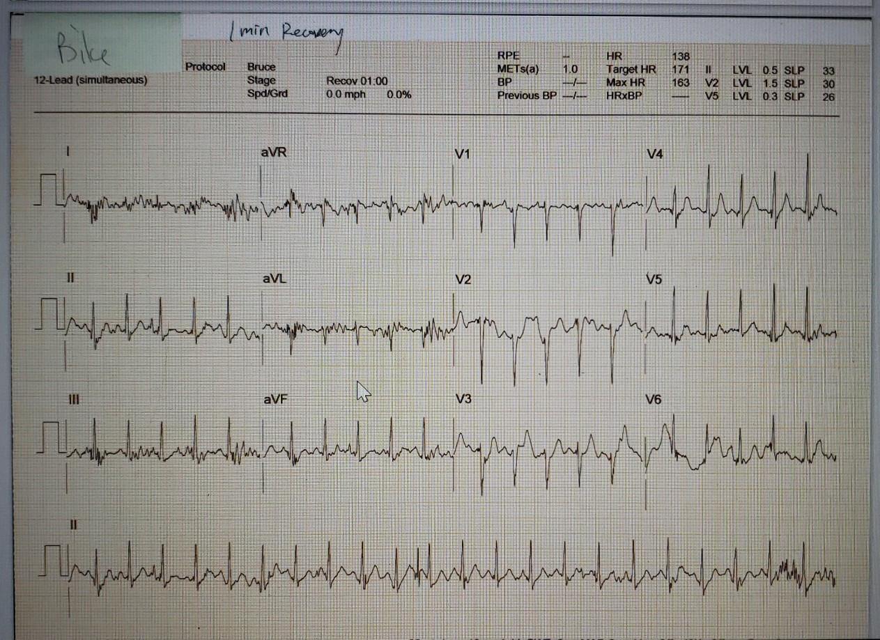 Bike (min Recovery Protocol Bruce Stage Spd/Grd | Chegg.com