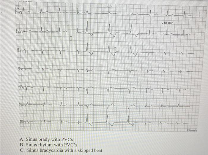Solved A. Venticular Fibrillation B. Atrial Fibrillation C. | Chegg.com
