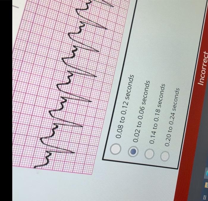 Sinus Arrhythmia Sinus Rhythm with PVC Sinus Rhythm | Chegg.com
