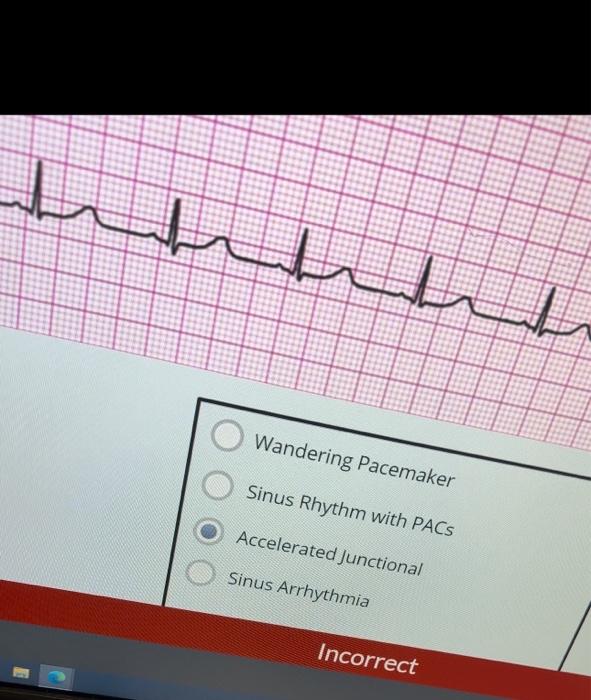 Solved 2nd Degree Type I AV Block, Wenckebach 3rd | Chegg.com