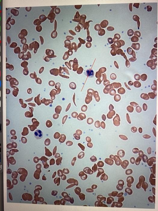 Solved 8. on abo Examine the sickle cell blood smear | Chegg.com