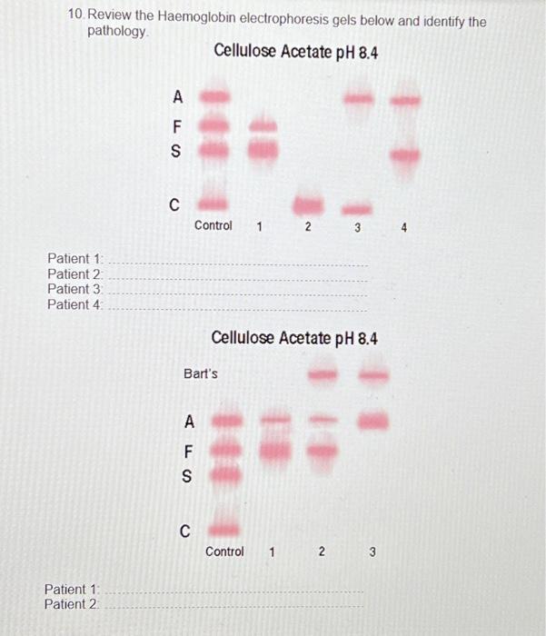 Solved Review the haemoglobin electrophoresis gels below and | Chegg.com