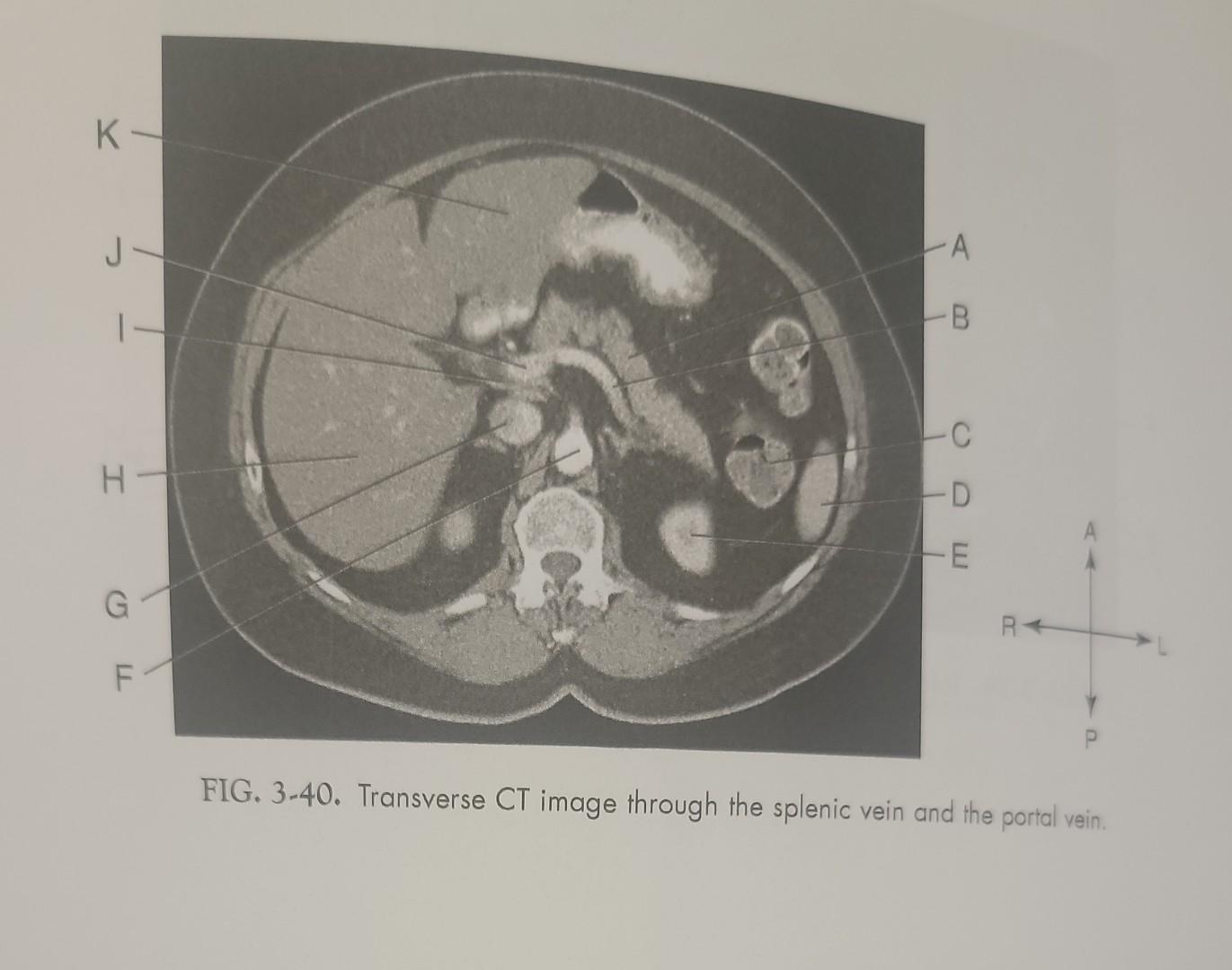 Solved FIG. 3-40. Transverse CT image through the splenic | Chegg.com