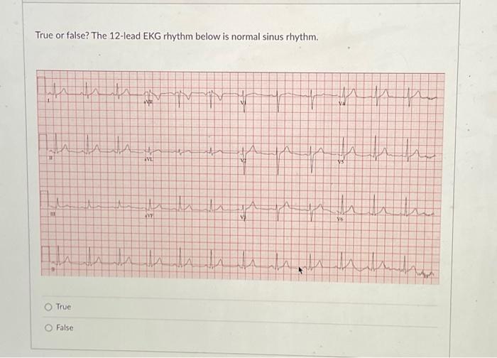 Solved True or false? The 12-lead EKG rhythm below is normal | Chegg.com