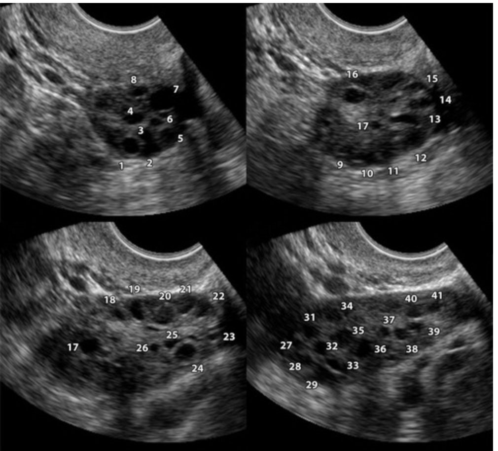 Solved Trans-vaginal ultrasound finds an abnormally high | Chegg.com