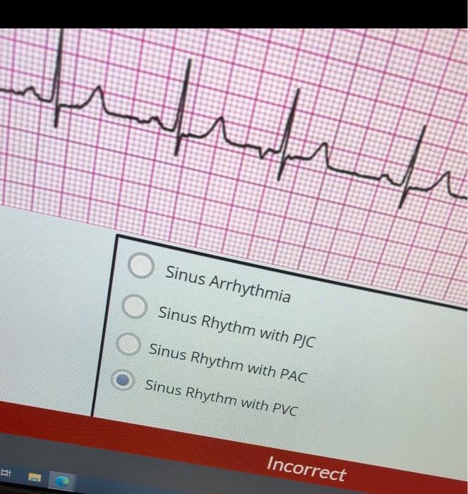 Sinus Arrhythmia Sinus Rhythm with PVC Sinus Rhythm | Chegg.com