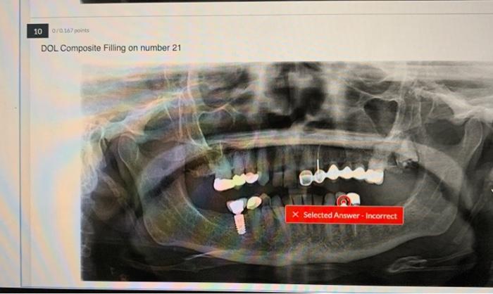10 0/0.167 points DOL Composite Filling on number 21 | Chegg.com