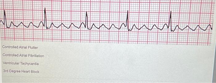 Solved Sinus Tachycardia Normal Sinus Rhythm 1st Degree | Chegg.com