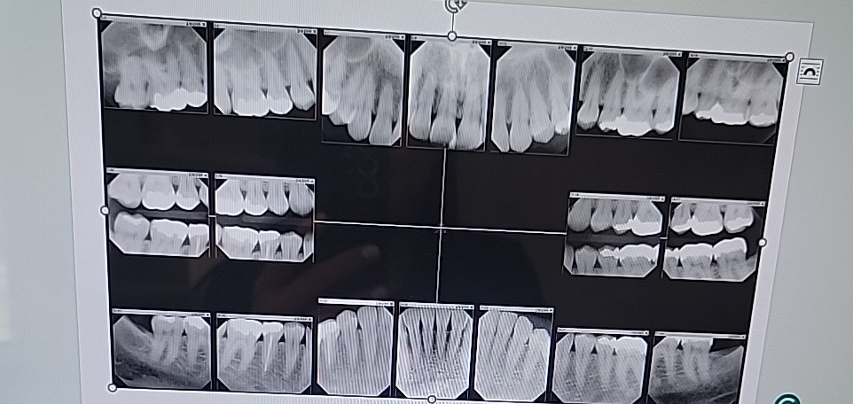 Solved what type of filling has the tooth number 29 | Chegg.com