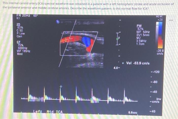 This internal carotid artery (ICA) spectral waveform | Chegg.com