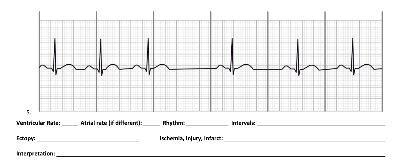 Ventricular Rate:Atrial rate (if | Chegg.com