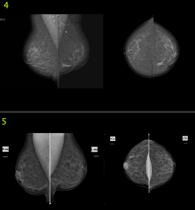 Solved the image below are mammography images please | Chegg.com
