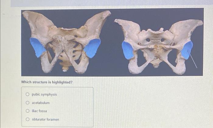 Solved PAL: Cadaver > Appendicular Skeleton: Pelvic Girdle > | Chegg.com