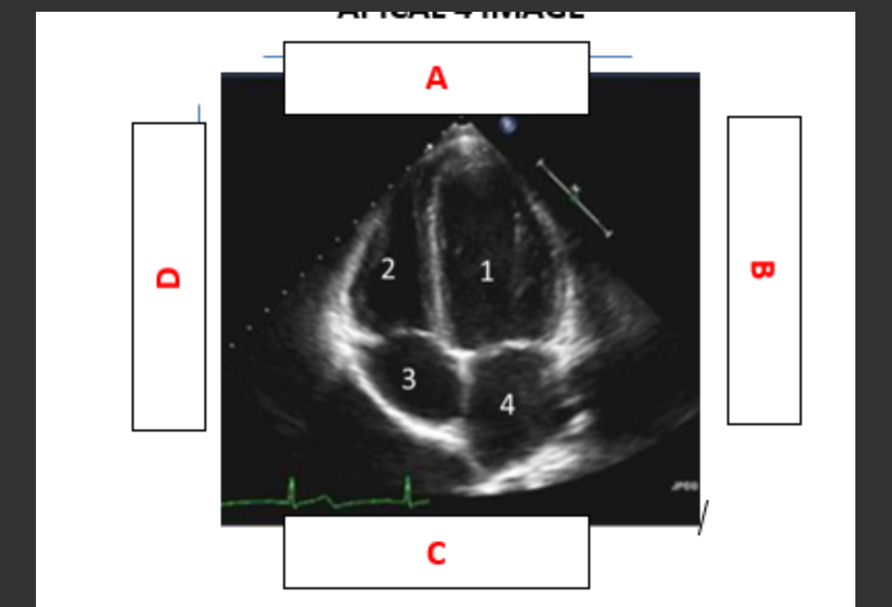 Solved by an EXPERT Label the orientation of plax heart if patient is ...