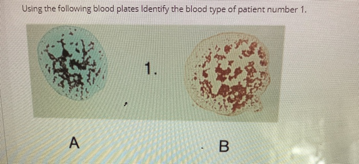 Solved Using the following blood plates Identify the blood | Chegg.com