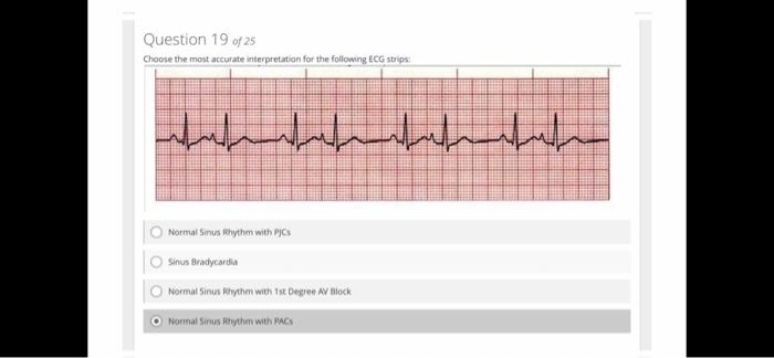 Solved Normai Sinus Whythen wet PjCs Sinus Bradycardia | Chegg.com
