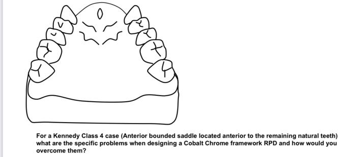 Solved For a Kennedy Class 4 case (Anterior bounded saddle | Chegg.com