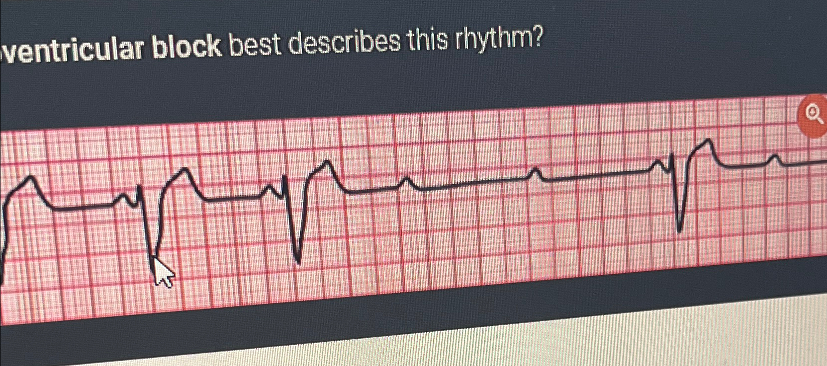 Solved ventricular block best describes this rhythm? | Chegg.com