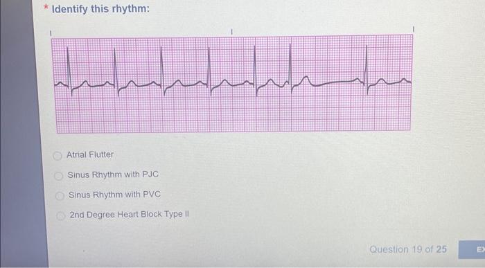 Solved ∗ Identify This Rhythm Atrial Flutter Sinus Rhythm