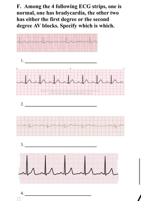 Solved F. Among the 4 following ECG strips, one is normal, | Chegg.com