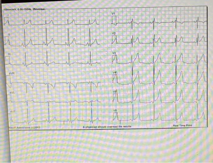Solved how do you calculate average R-to-R (mm) from an ECG? | Chegg.com