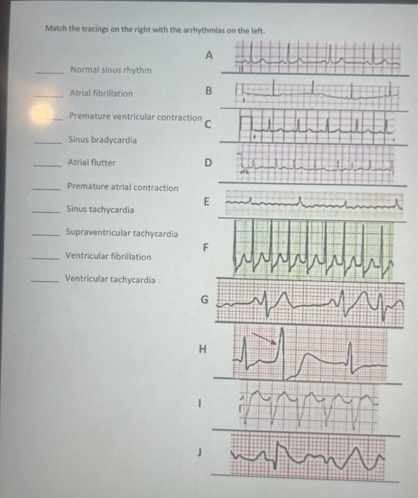 Solved Match the tracings on the right with the art Normal | Chegg.com