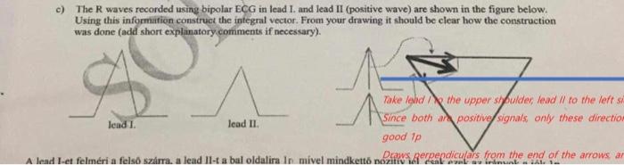 The R waves recorded using bipolar ECG in lead I. and | Chegg.com