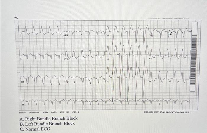 Solved B. Left Bundle Branch Block C. Normal ECG | Chegg.com