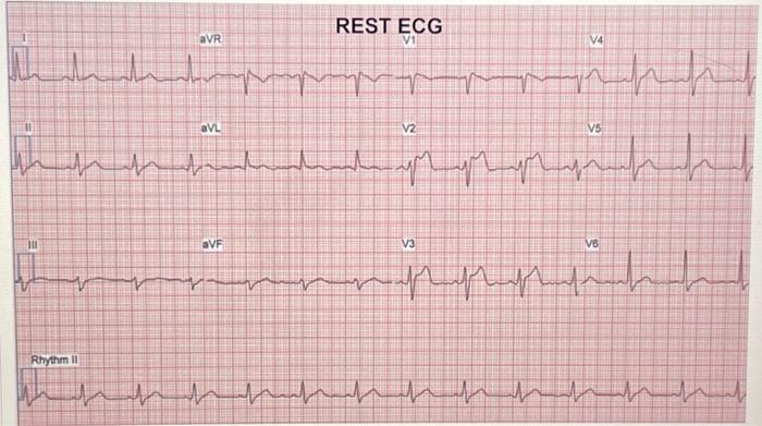 Solved Using the "rest ECG" in the assignment page in | Chegg.com