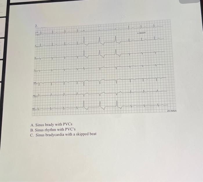 Solved A. Sinus brady with PVCs B. Sinus rhythm with PVC's | Chegg.com