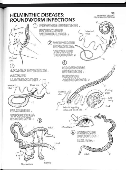 Solved HELMINTHIC DISEASES: ROUNDWORM INFECTIONS FILARlasis. | Chegg.com