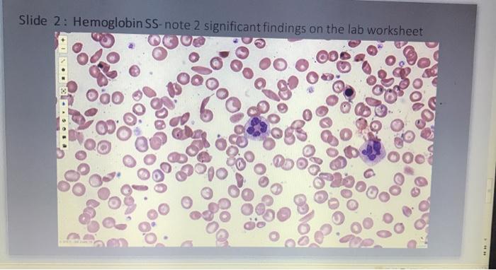 Solved Slide 1: Hemoglobin CC - note 2 significant findings | Chegg.com
