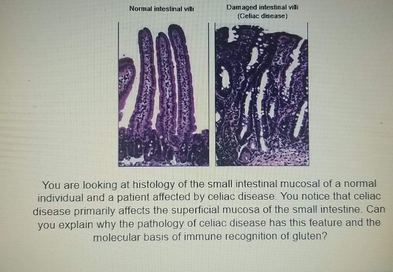 Solved Normal intestinal villi Damaged intestinal vili | Chegg.com