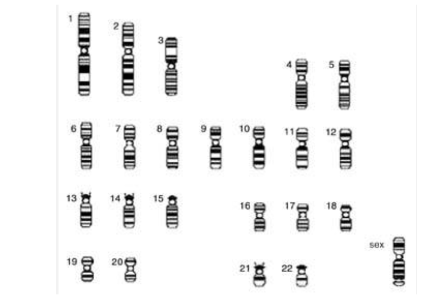 Solved This karyotype reveals a trisomy of the 13th | Chegg.com