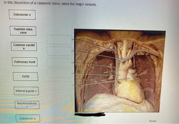 Solved In this dissection of a cadaveric torso, label the | Chegg.com
