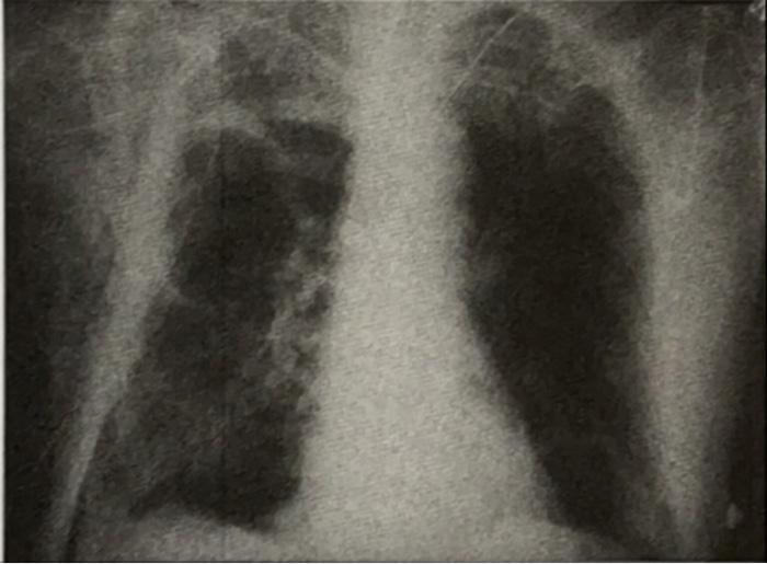 Solved Case Study #2: Emphysema | Chegg.com