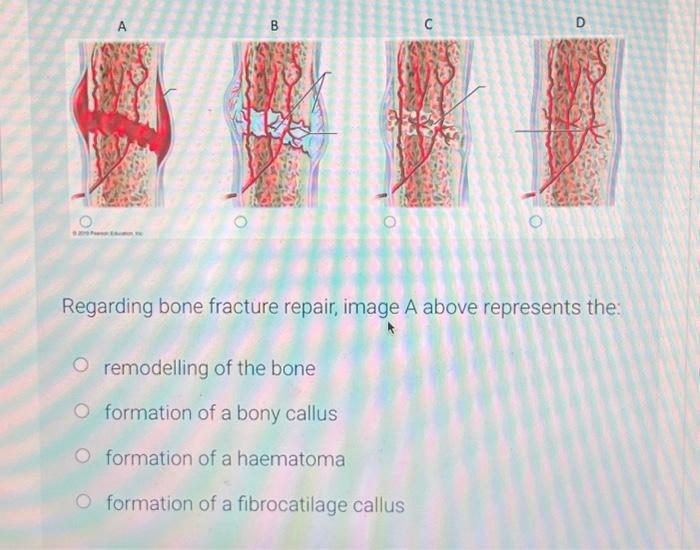 Solved Regarding bone fracture repair, image A above | Chegg.com