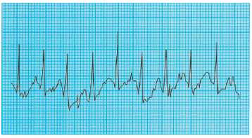 For the ECG shown in the figure below, the time scale | Chegg.com