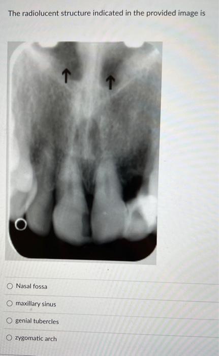 What is the large radiolucent structure indicated in | Chegg.com