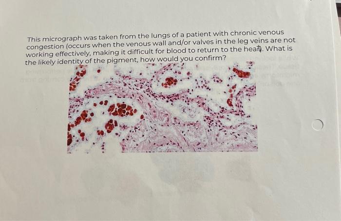 Solved This micrograph was taken from the lungs of a patient | Chegg.com