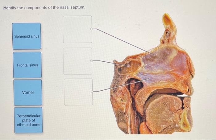 Solved Identify the components of the nasal septum. Sphenoid | Chegg.com