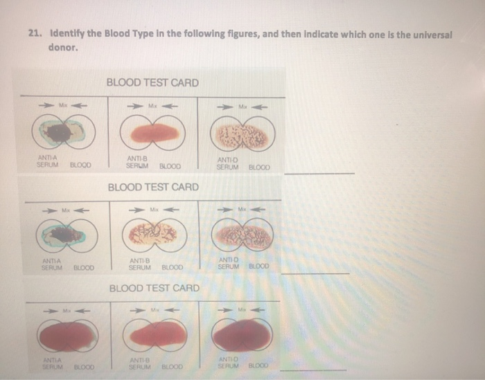 Solved 21. Identify the Blood Type in the following figures, | Chegg.com