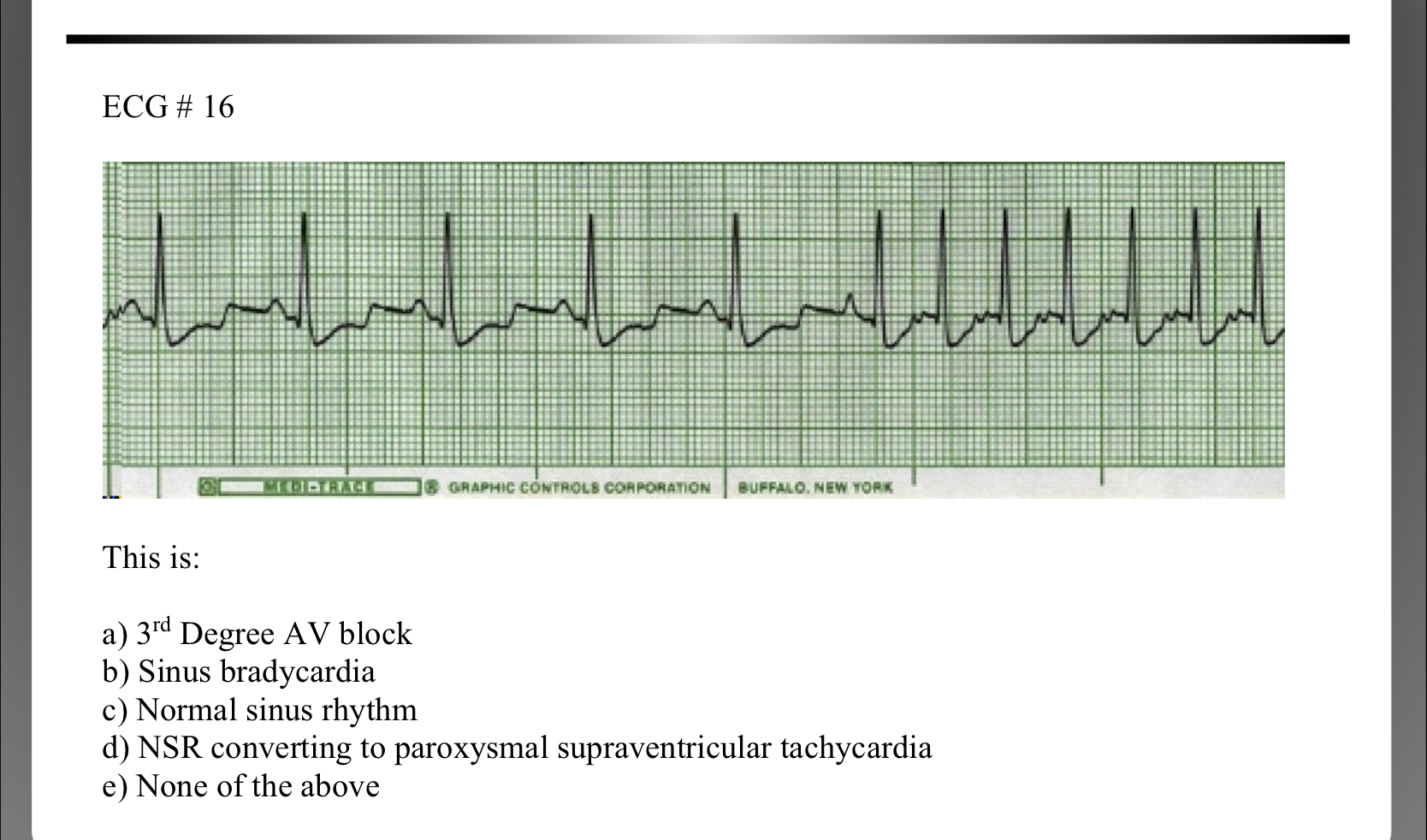 Solved ECG # 16This is:a) 3rd ﻿Degree AV blockb) ﻿Sinus | Chegg.com