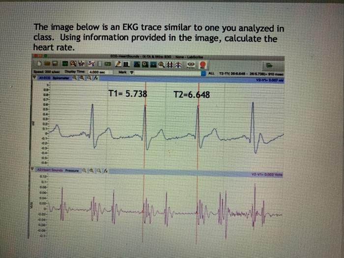 Solved The image below is an EKG trace similar to one you | Chegg.com