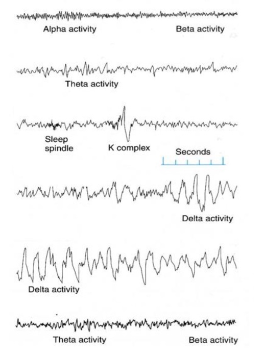 Solved 1) EEG can be used to measure the stages of sleep. On | Chegg.com