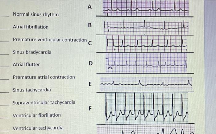 Solved А Normal Sinus Rhythm Atrial Fibrillation B Premature