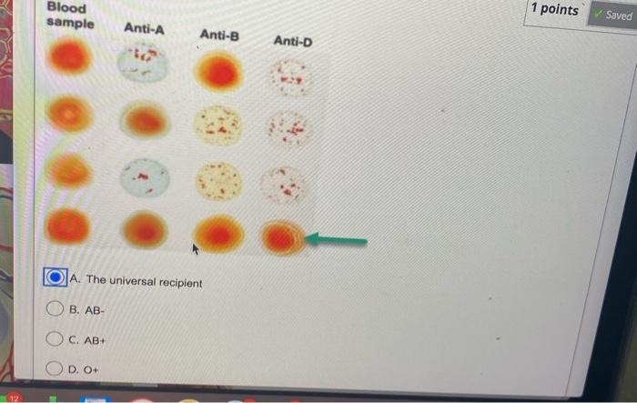 Solved A. The universal recipient B. AB - C. AB+ D. O+ | Chegg.com