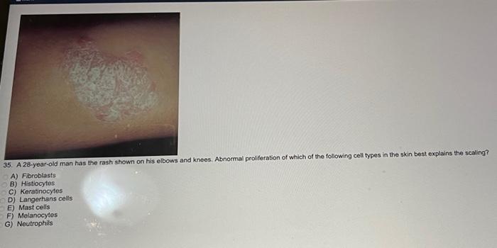 Solved 35. A 28-year-old man has the rash shown on his | Chegg.com