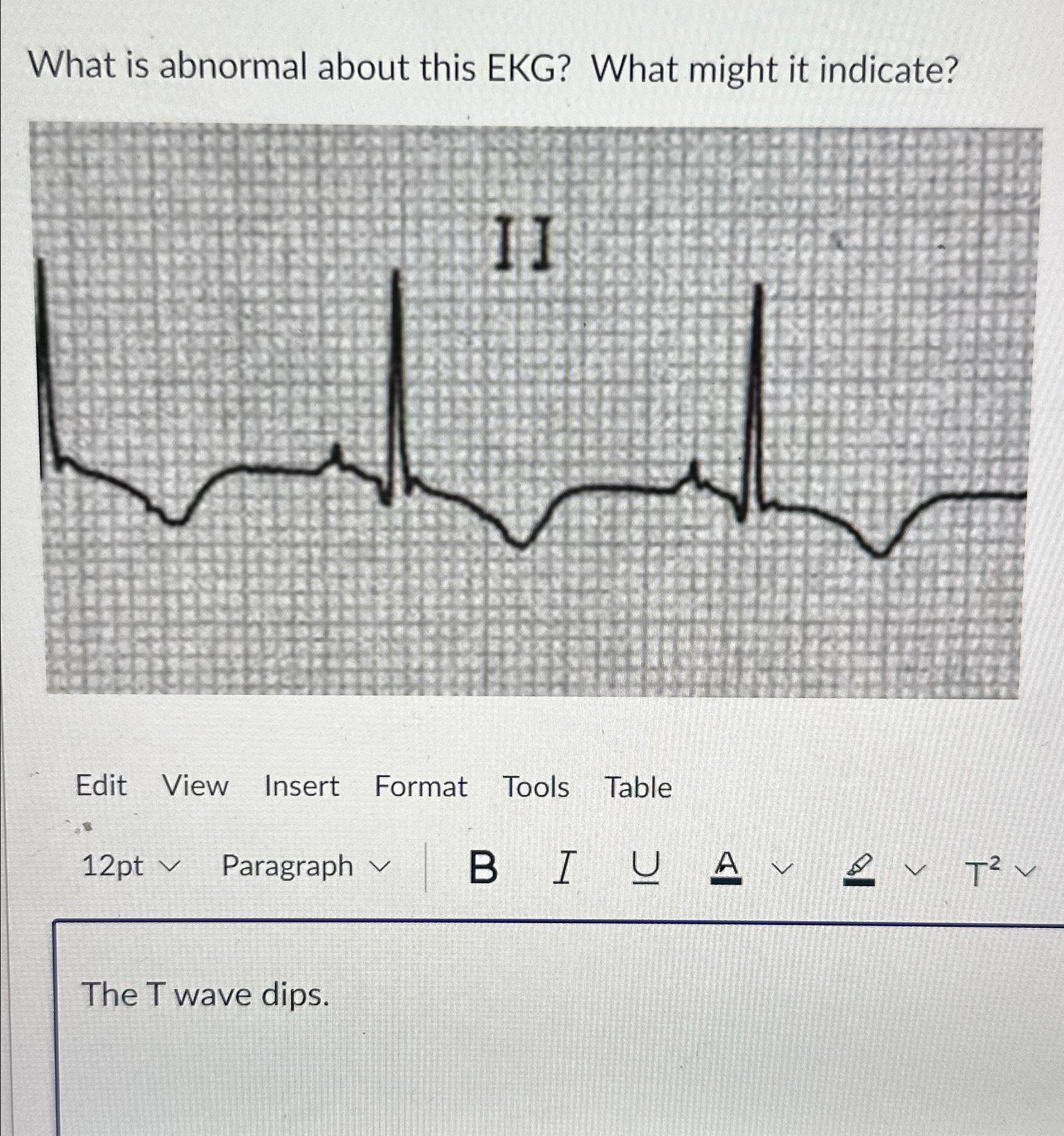 Solved What is abnormal about this EKG? What might it | Chegg.com